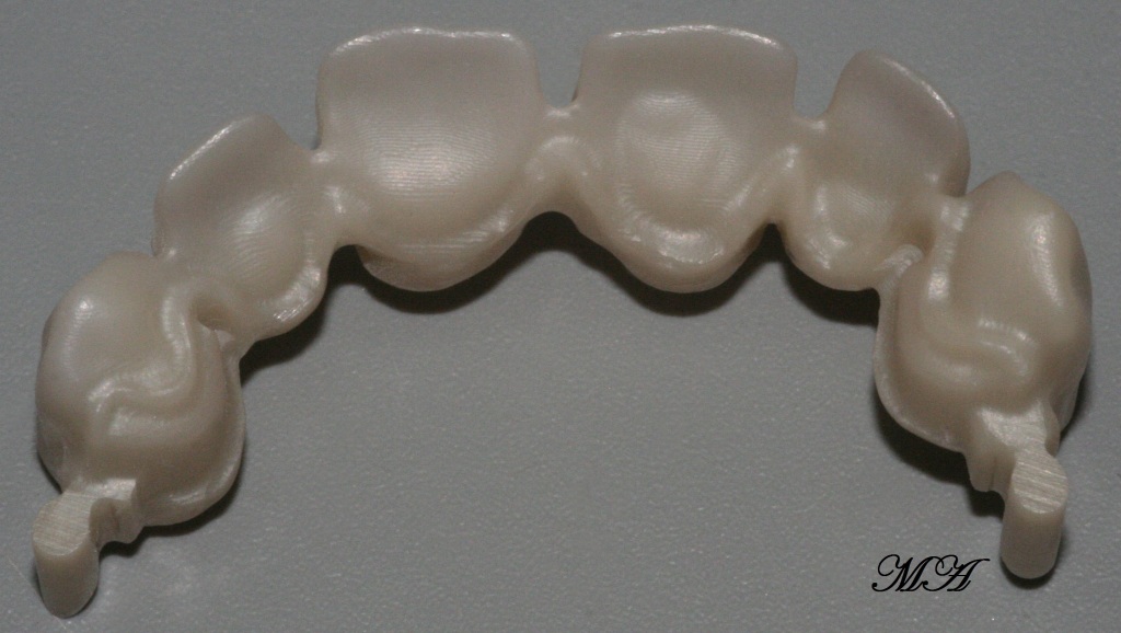 Zirkon & Geschiebe / Zirconium & Attachments | DENTALLIGENT | Blog