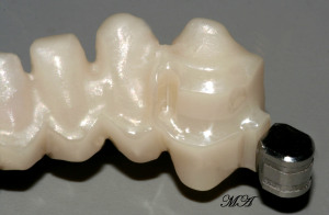 Zirkon & Geschiebe / Zirconium & Attachments | DENTALLIGENT | Blog