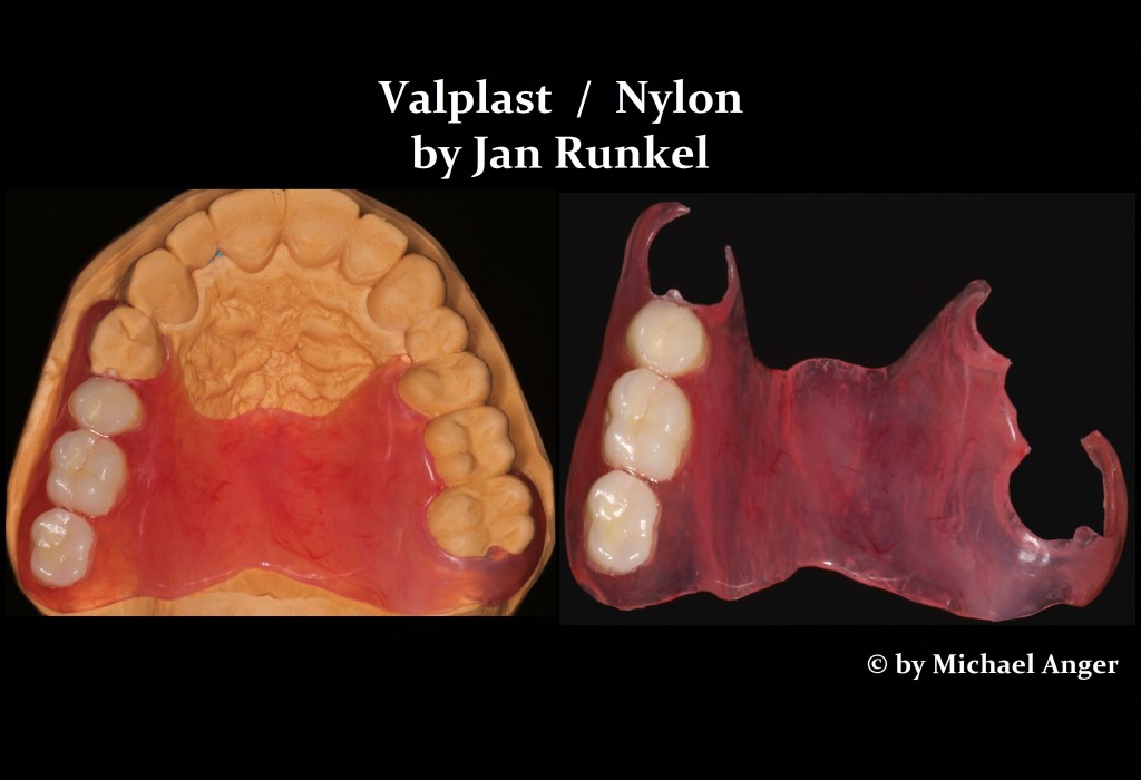 Valplast Prothesen aus Nylon | DENTALLIGENT | Blog