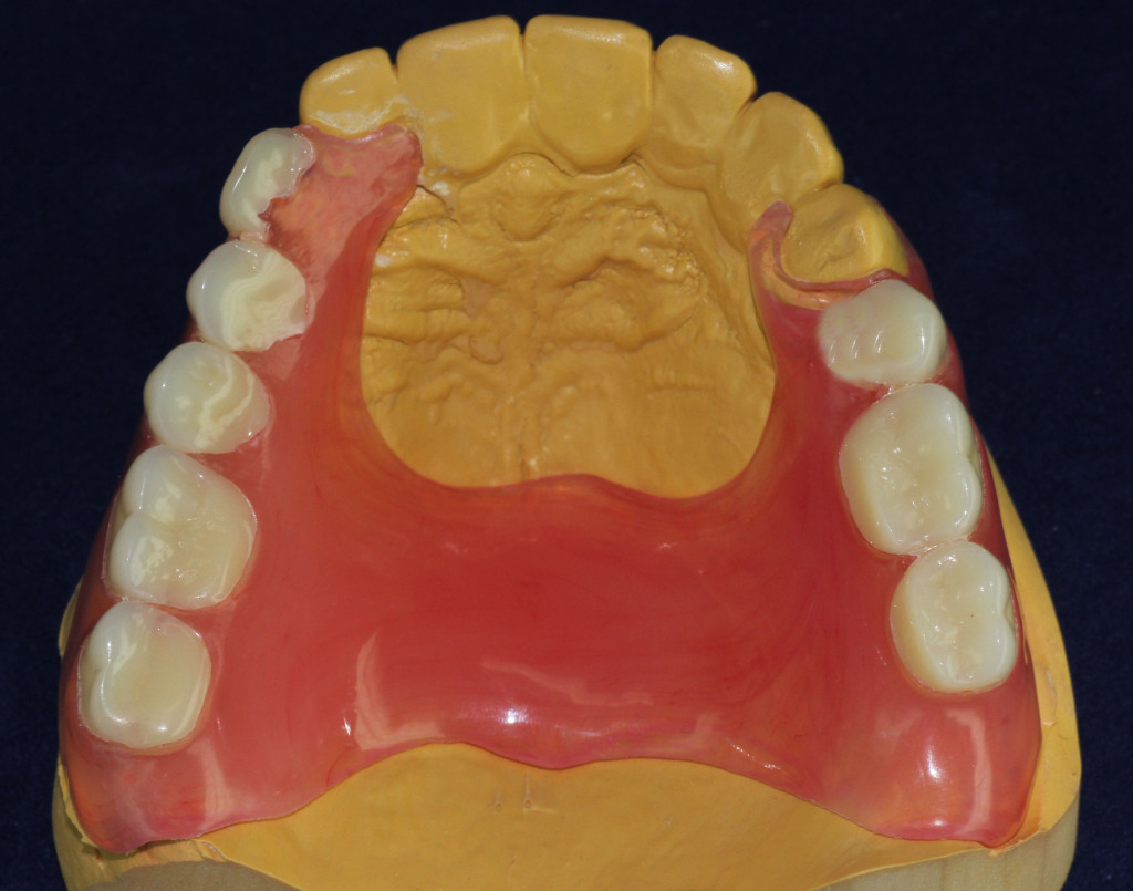 Valplast Prothesen aus Nylon | DENTALLIGENT | Blog