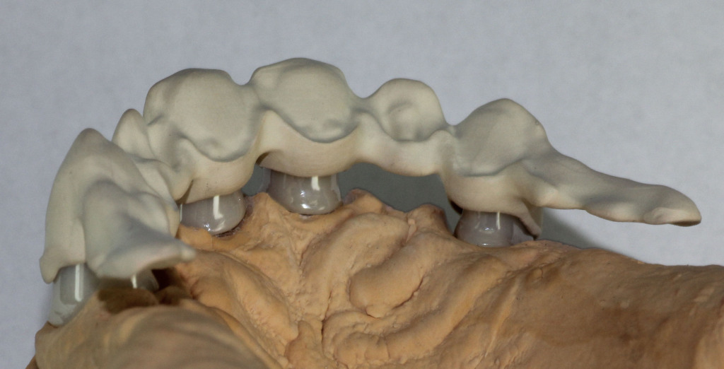 Zahnfarbenes PEEK / tooth-colored PEEK | DENTALLIGENT | Blog