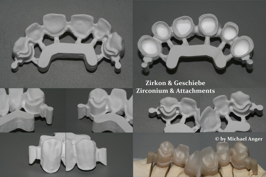 Zirkon & Geschiebe / Zirconium & Attachments | DENTALLIGENT | Blog