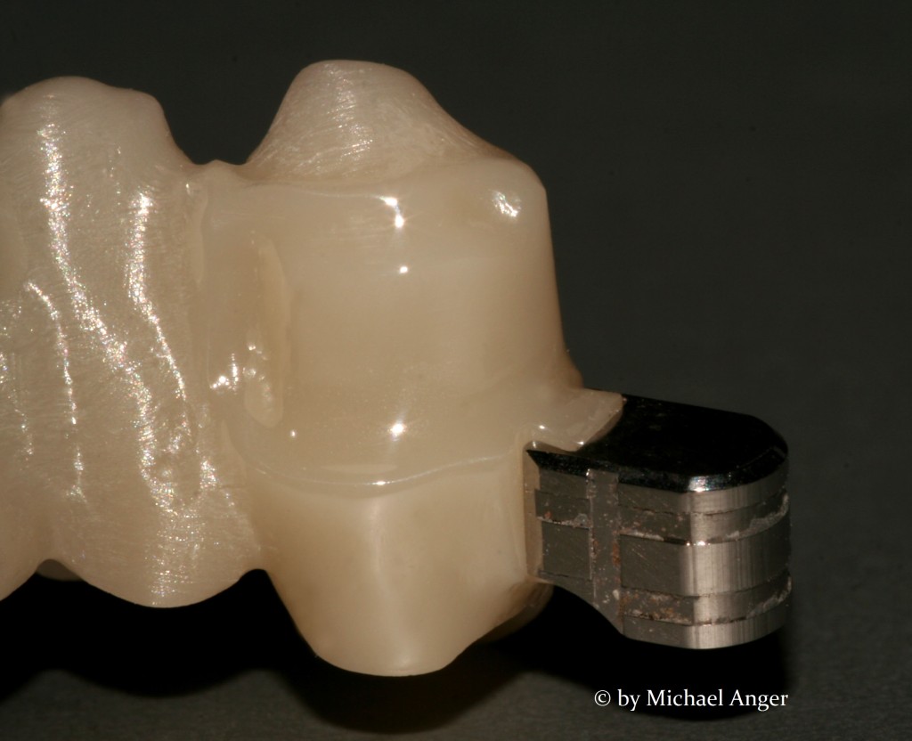 Zirkon & Geschiebe / Zirconium & Attachments | DENTALLIGENT | Blog