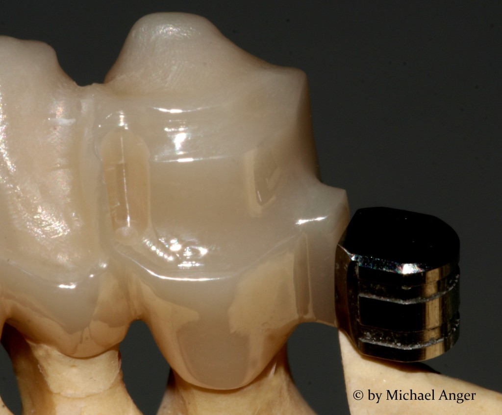 Zirkon & Geschiebe / Zirconium & Attachments | DENTALLIGENT | Blog