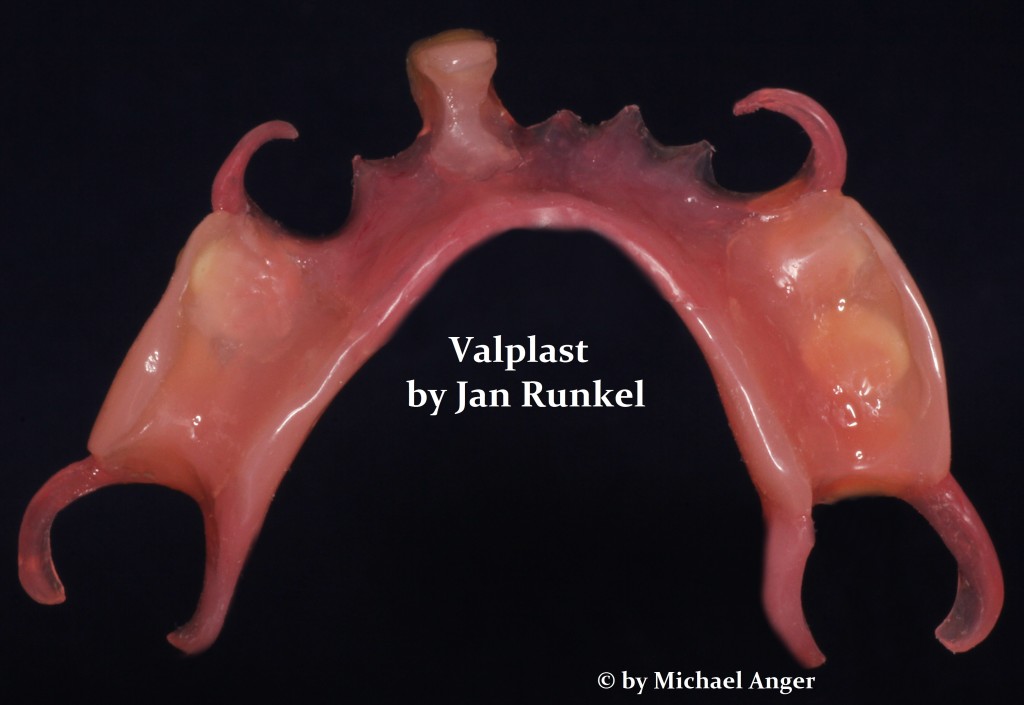 Valplast Prothesen aus Nylon | DENTALLIGENT | Blog