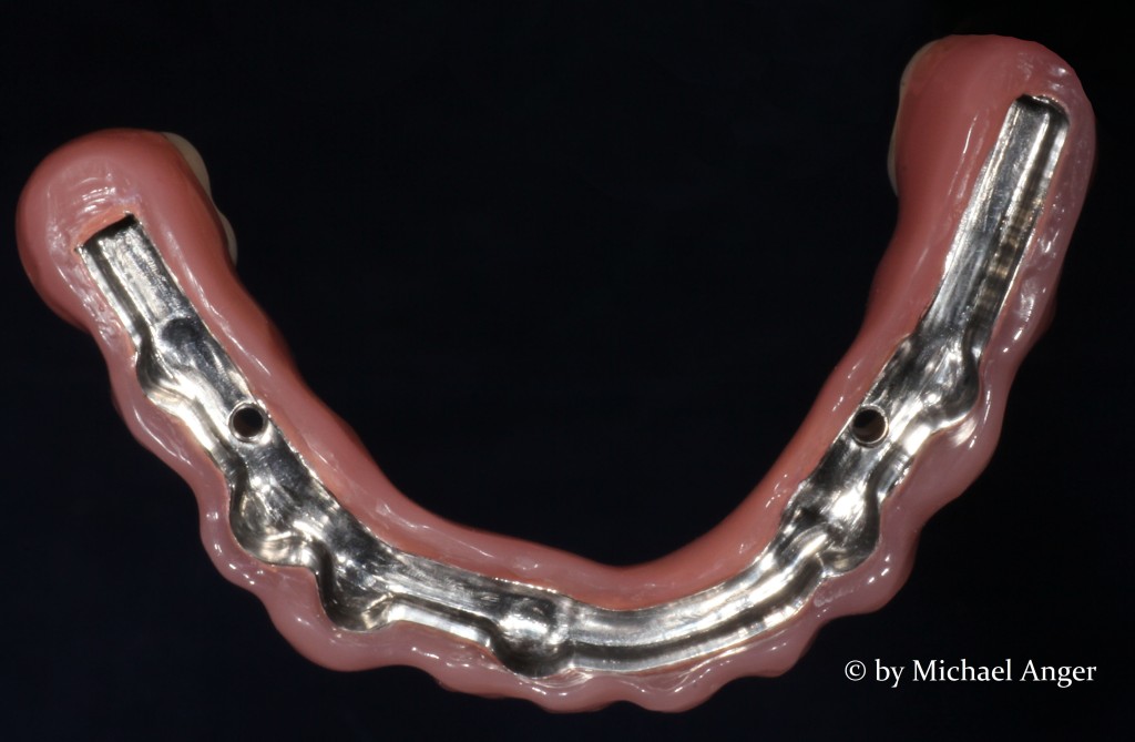Implantatsteg / Implant-bar Part 4 / Teil 4 | DENTALLIGENT | Blog