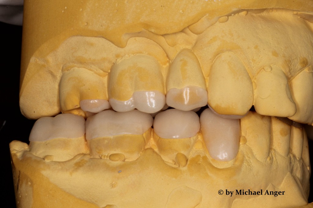 Table Tops & Composite | DENTALLIGENT | Blog