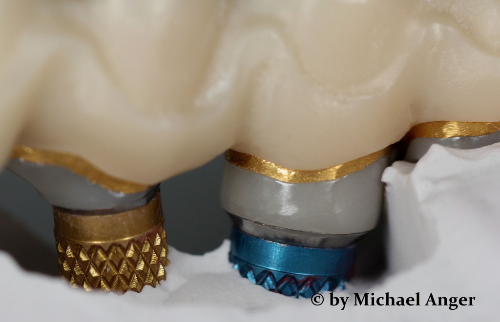 Zirkon & Galvano / Zirconium & Galvano | DENTALLIGENT | Blog