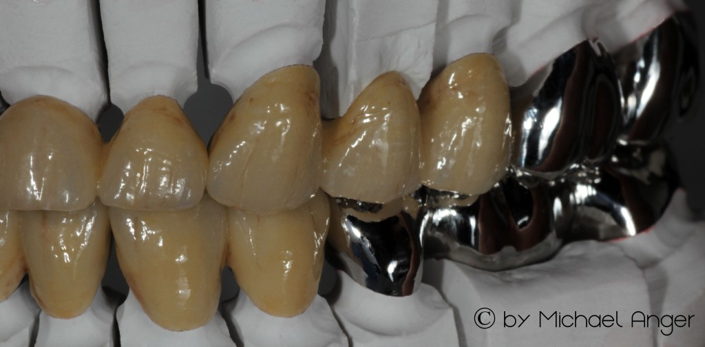 Kassenleistung & Komplettversorgung mit NEM und Keramik | DENTALLIGENT ...