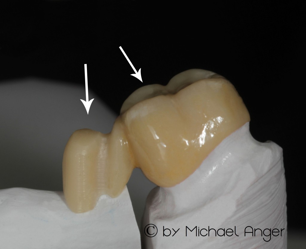 Divided Bridge in Zirconia | DENTALLIGENT | Blog