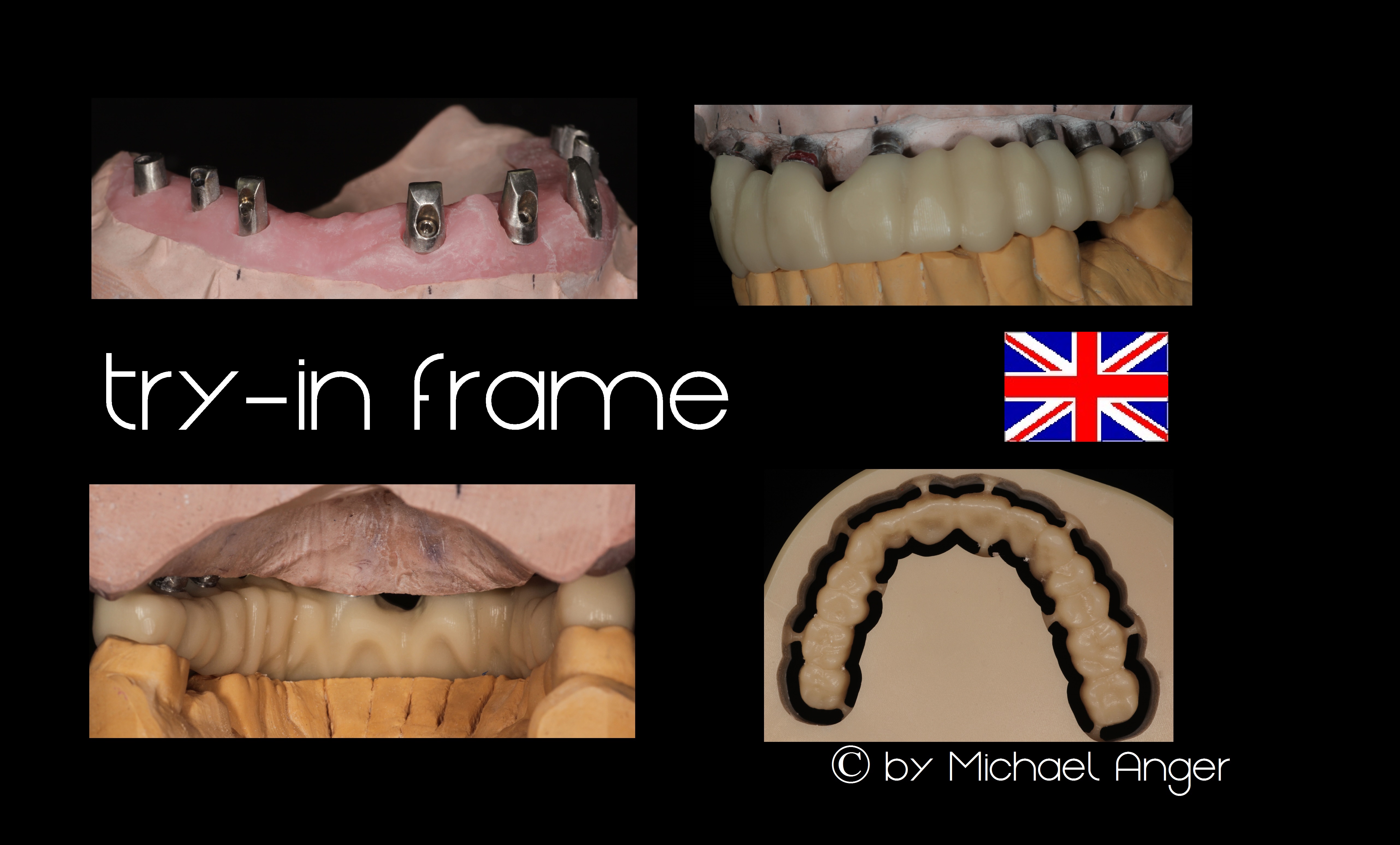 Implant try-in Einprobe provisorisches Gerüst im Artikulator collage ...