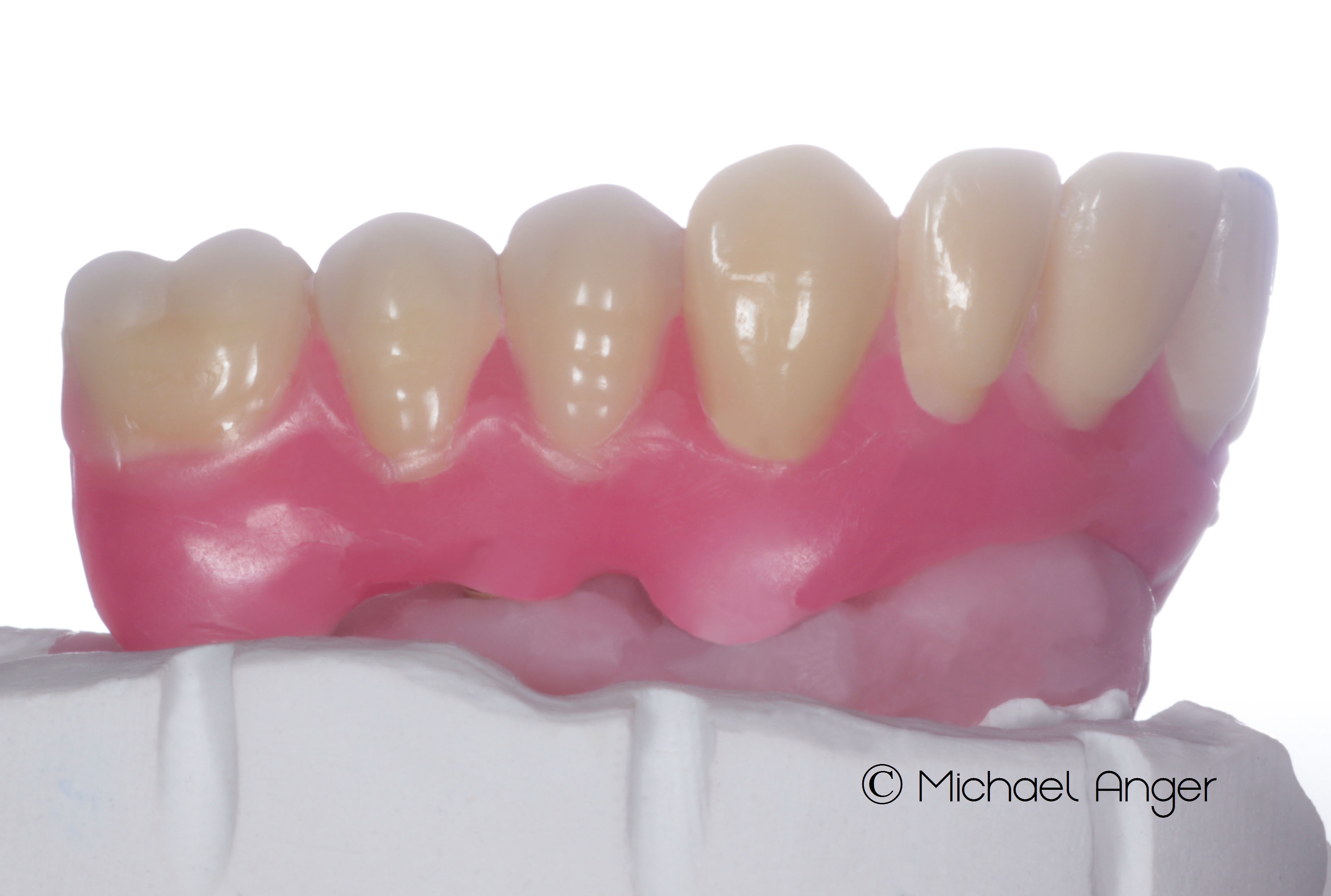 9. PEEK-Teleskope Sekundärteleskope als Teleskopbrücke auf Implantaten ...