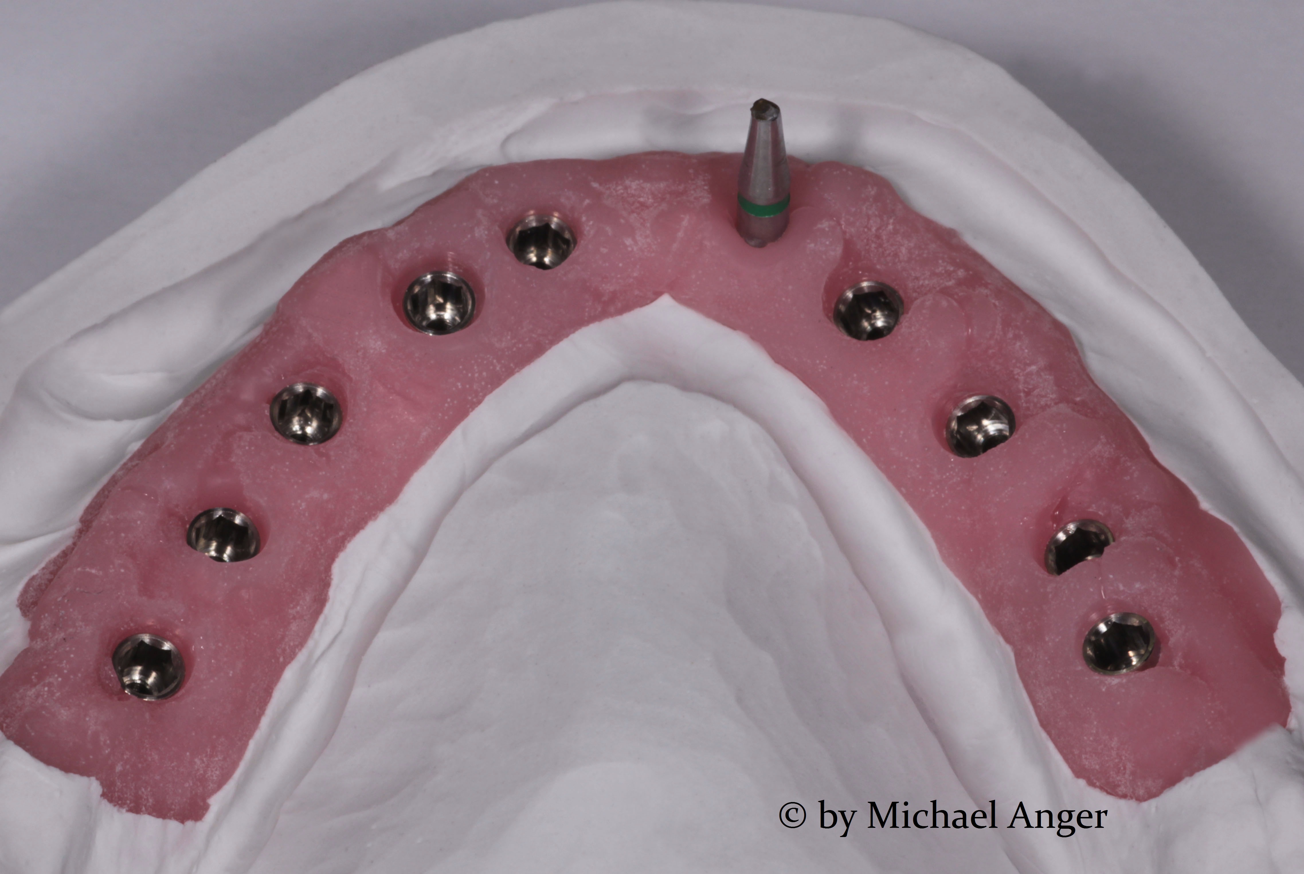 Das Modell nach dem Ausgiessen mit Gips. Die Zahnfleischmasken und der ...